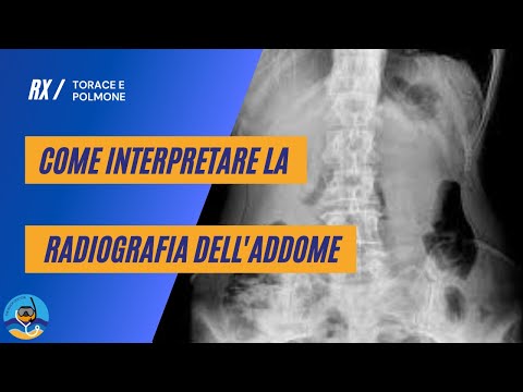 Come interpretare la radiografia dell'addome - YouTube