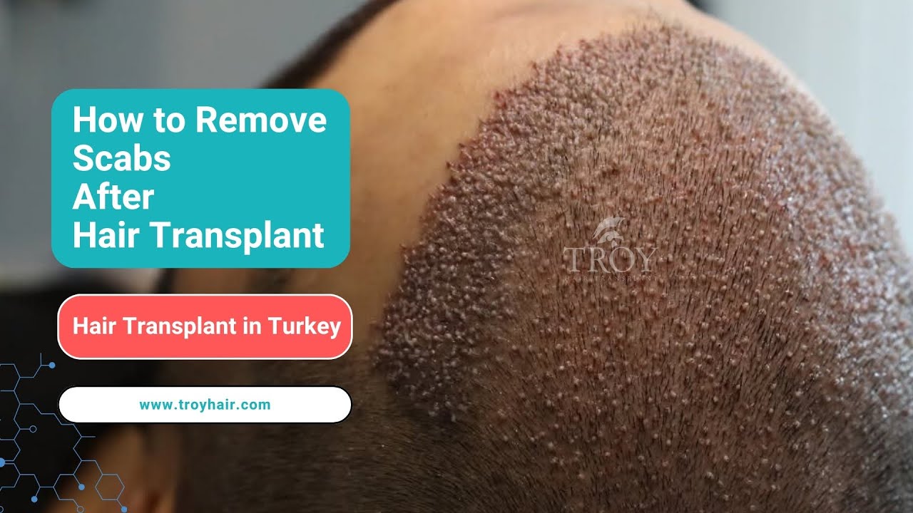 Hair Transplant in Turkey | Removing Scabs After Hair Transplant | Troy ...