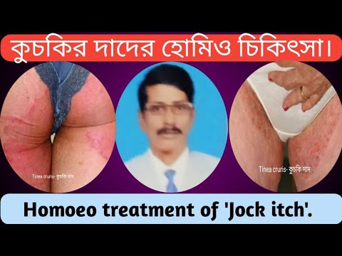 (99) কুঁচকির দাদের হোমিও চিকিৎসা-Homoeo treatment of 'Jock itch'. - YouTube