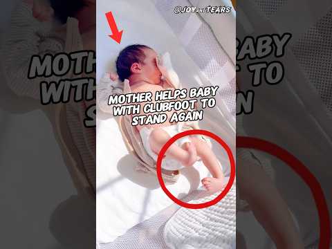 Mom helps the baby with horseshoe feet to regain standing🥰#shorts