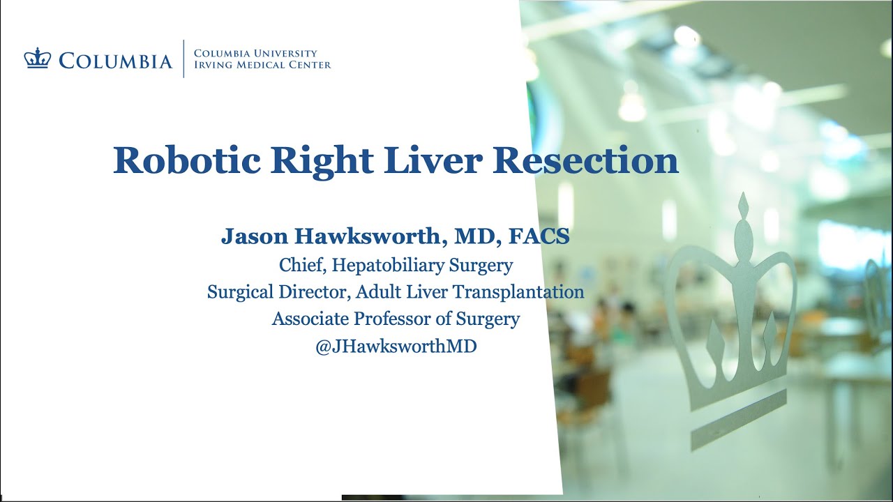 "Robotic Right Liver Resection" | Lecture for 3rd International Robotic ...