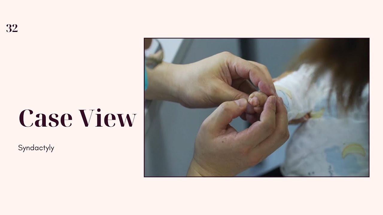 Complex Syndactyly with All Fingers Clustered - YouTube