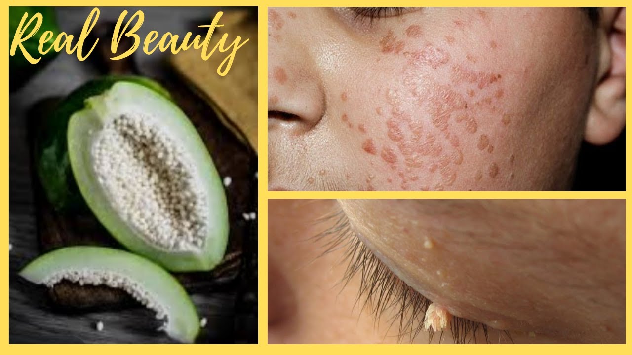 DIY Home Remedy To Remove Common Facial Warts - Try It Today Onwards ...