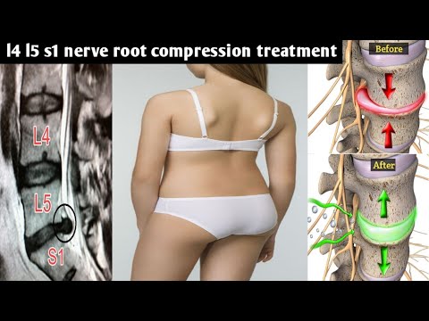 L4-L5-S1 nerve root compression treatment, disc bulge treatment without surgery, back pain ...