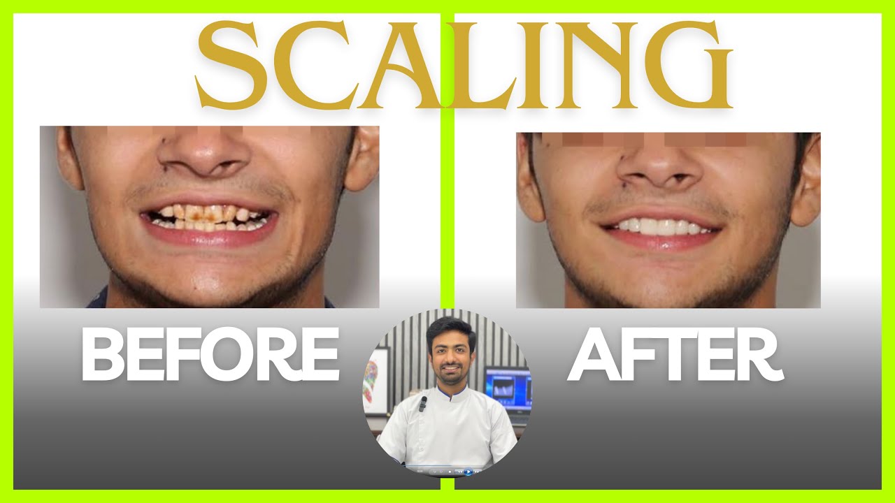 Scaling करवाना क्यों ज़रूरी है ? |Why Scaling is Important ?| - YouTube