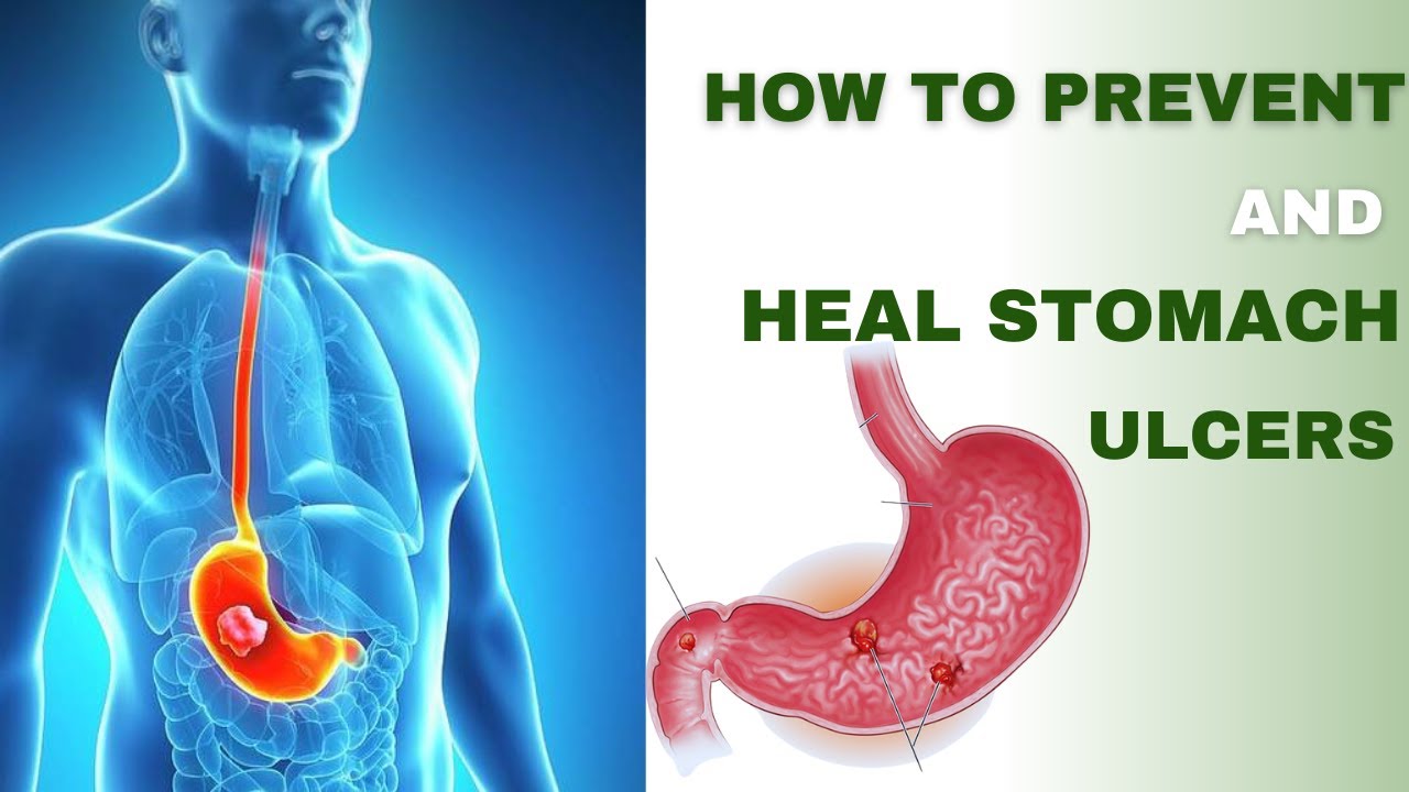 How to Prevent and Heal Stomach Ulcers - YouTube