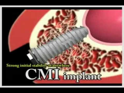 Maximum Dental Neobiotech CMI IS İmplant (Animasyon) - YouTube