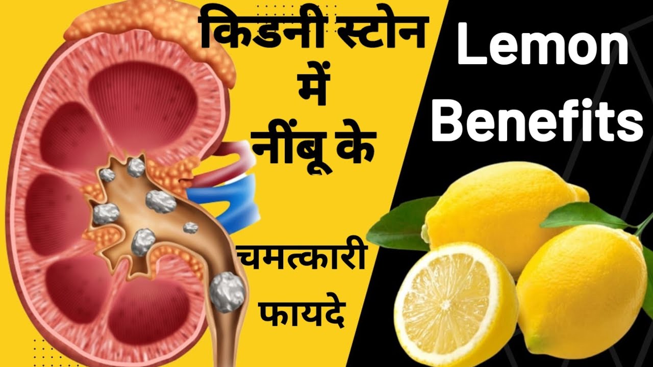 Kidney stones | पथरी के तेज दर्द में तुरंत राहत ? pathari me nimbu ke ...
