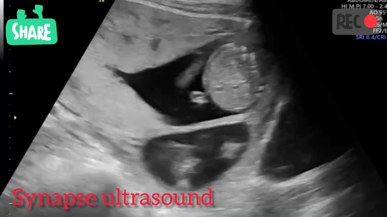 Amniotic Sheet - YouTube