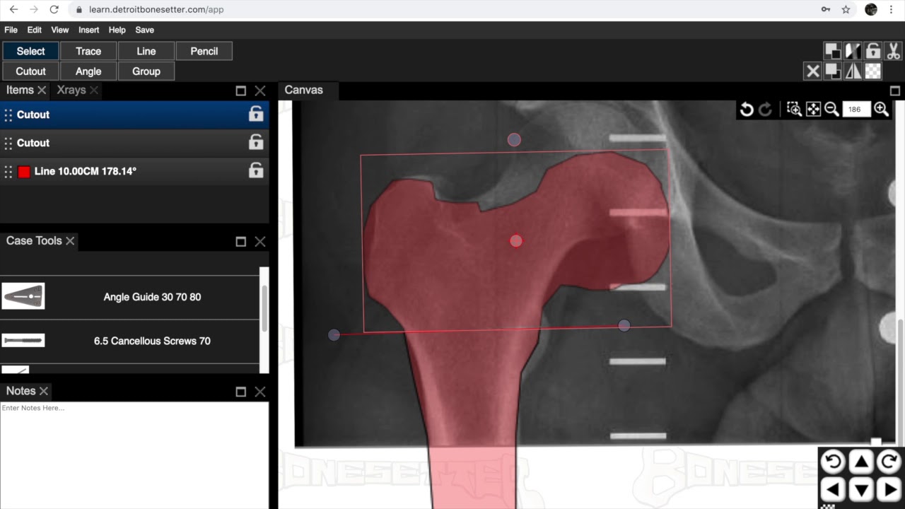 AO Advanced Osteotomy Primer for Bonesetter App - YouTube