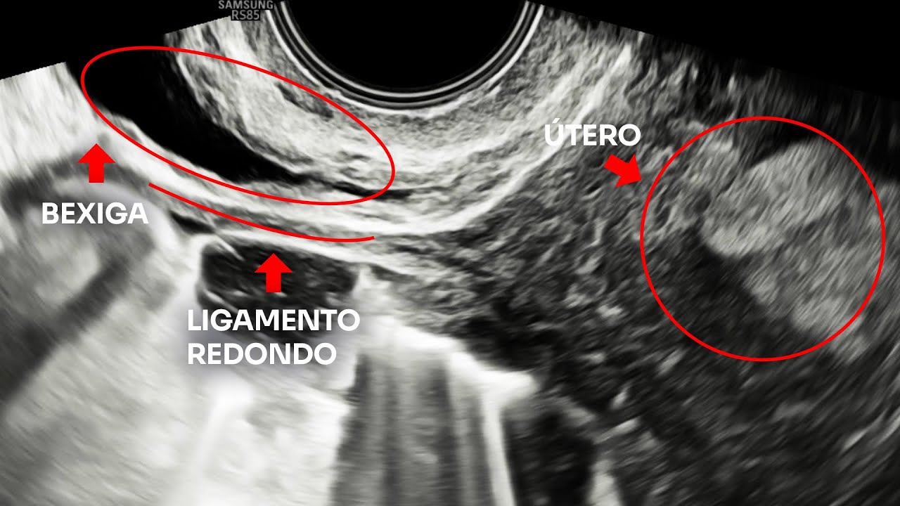 Estudando o compartimento anterior no USG TV - Guia Prático - YouTube