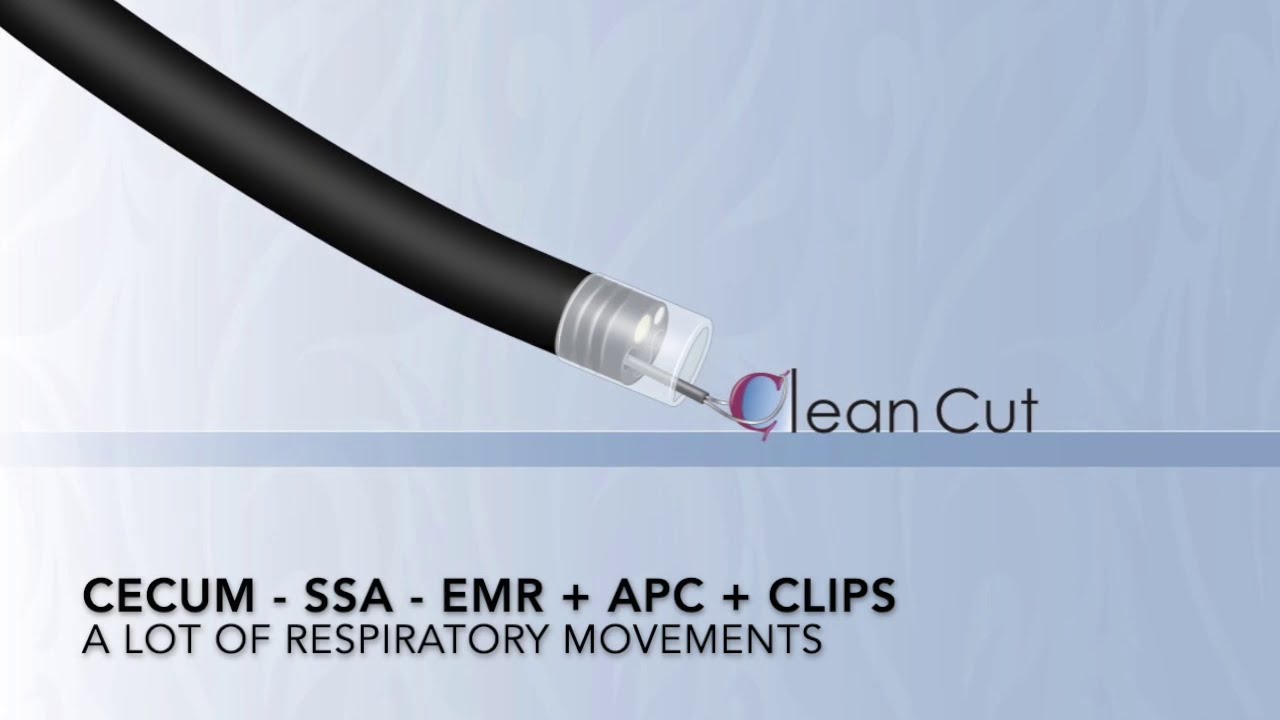 Colonoscopy: Cecum - Subtle SSA - EMR - YouTube