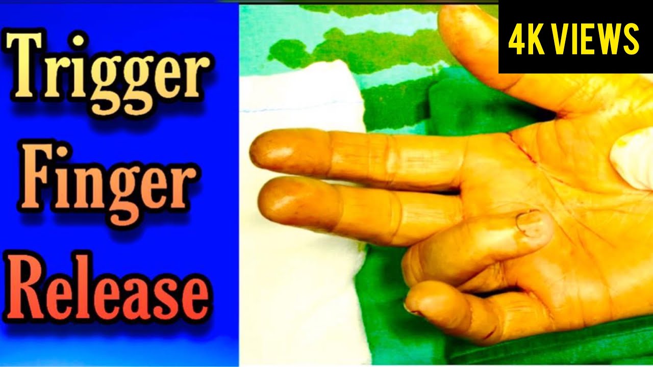 TRIGGER FINGER RELEASE LIVE SURGERY | HAND SURGERY | LOCKING & SNAPPING ...