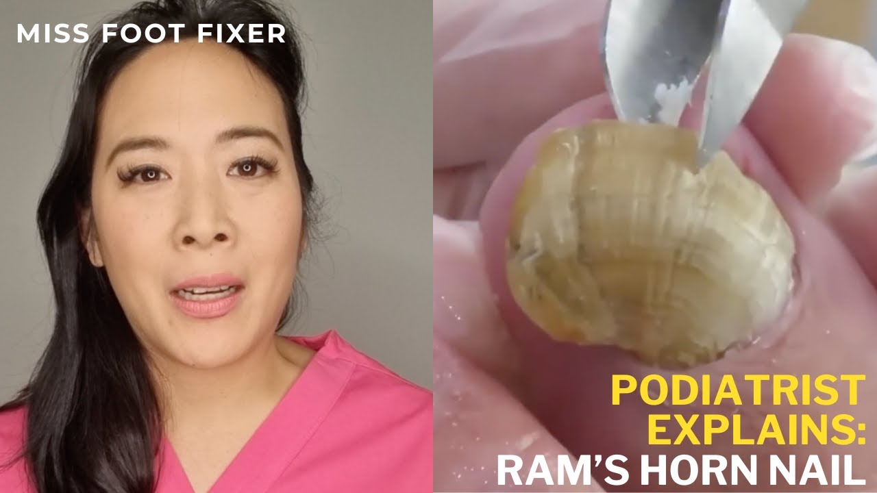 RAMS HORN TOENAILS | Trimming Extremely Long and Thick Toenails ...