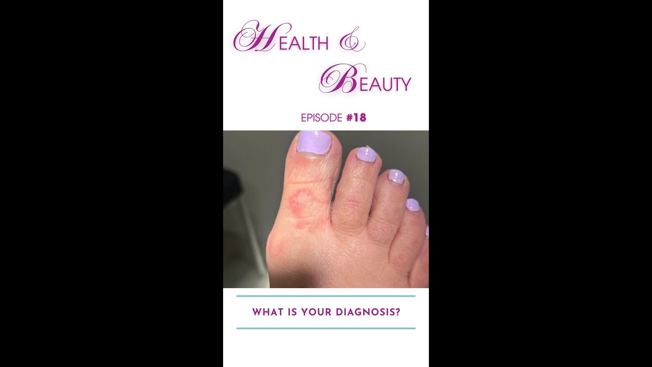 Cutaneous larva migrans (CLM) - YouTube