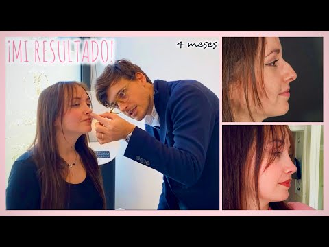 MI RINOPLASTIA tras 4 meses: experiencia + evolución + revisión🩺👃🏼💗