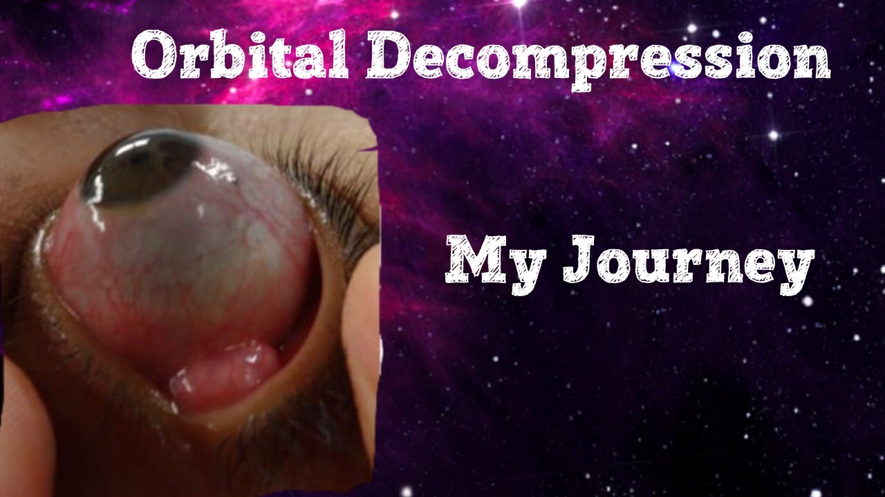 Orbital Decompression post opt right eye /pain and keeping it real ...