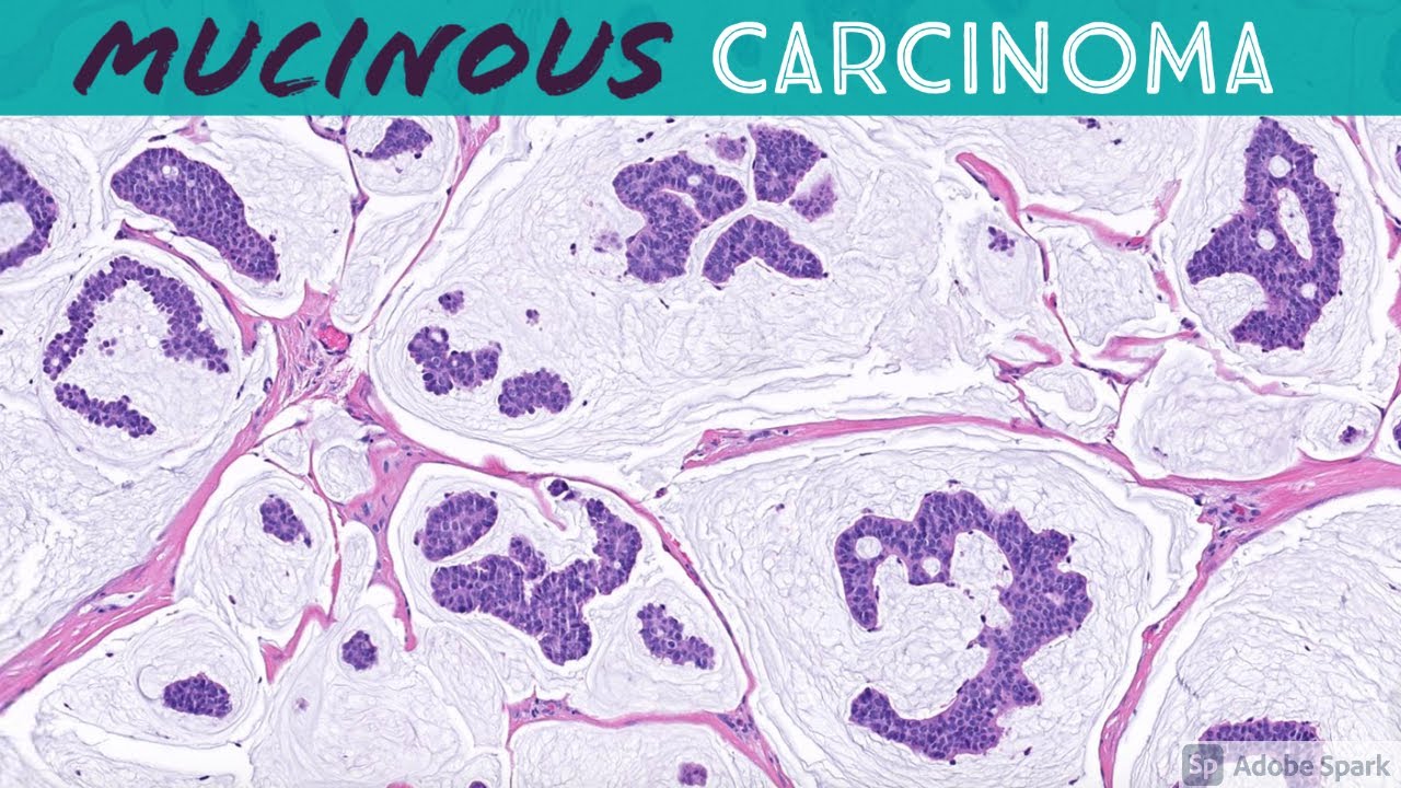 Primary Cutaneous Mucinous Carcinoma & Endocrine Mucin-Producing Sweat ...