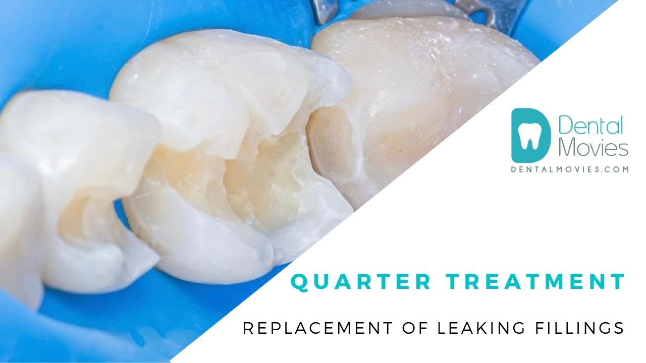 Quarter treatment, replacement of leaking fillings - YouTube