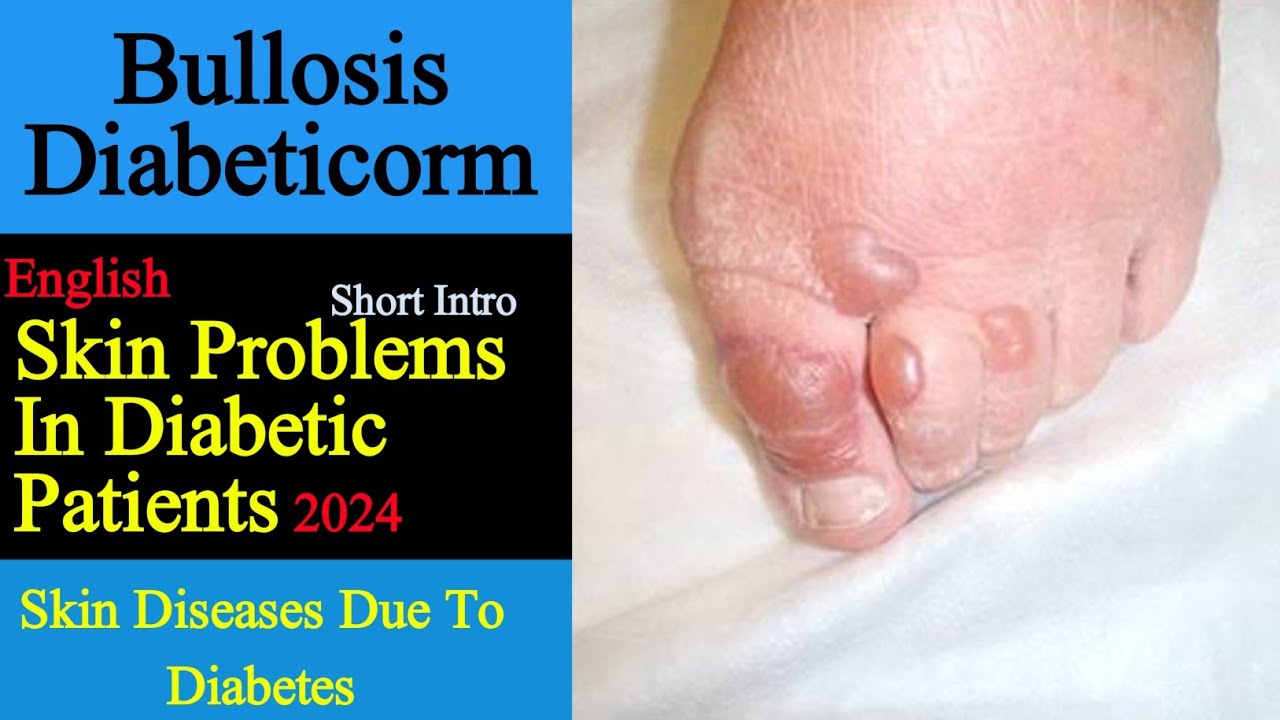 Diabetic Dermopathy I Diabetes Skin Diseases I Bullosis Diabetocorm I ...
