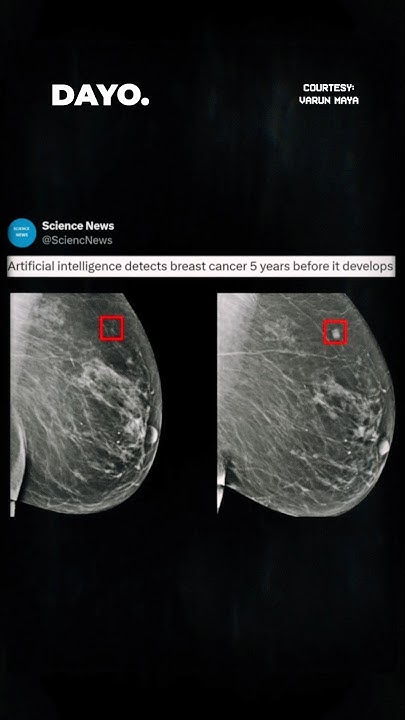 AI can Detect Brest Cancer 5 years Before - YouTube