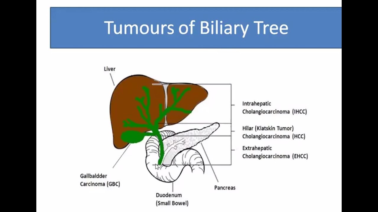 Carcinoma of Biliary Tree | Pancreas Tumors | Palliation | Surgery ...