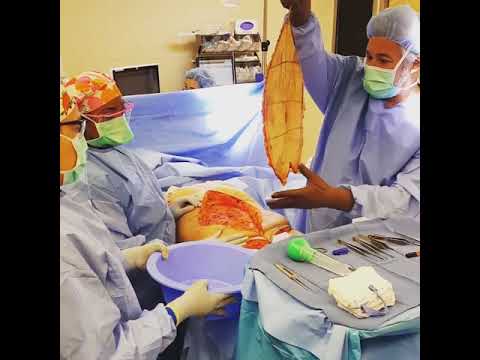 Extreme Skin Removal: FDL Tummy Tuck - YouTube Extreme Skin Removal: FDL Tummy Tuck - YouTube