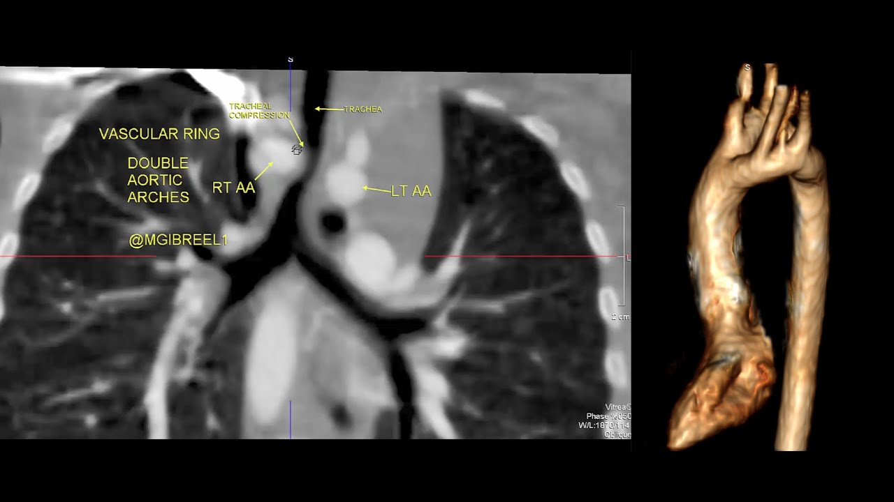 1 year child with stridor CT shows complete vascular ring , DAA ...