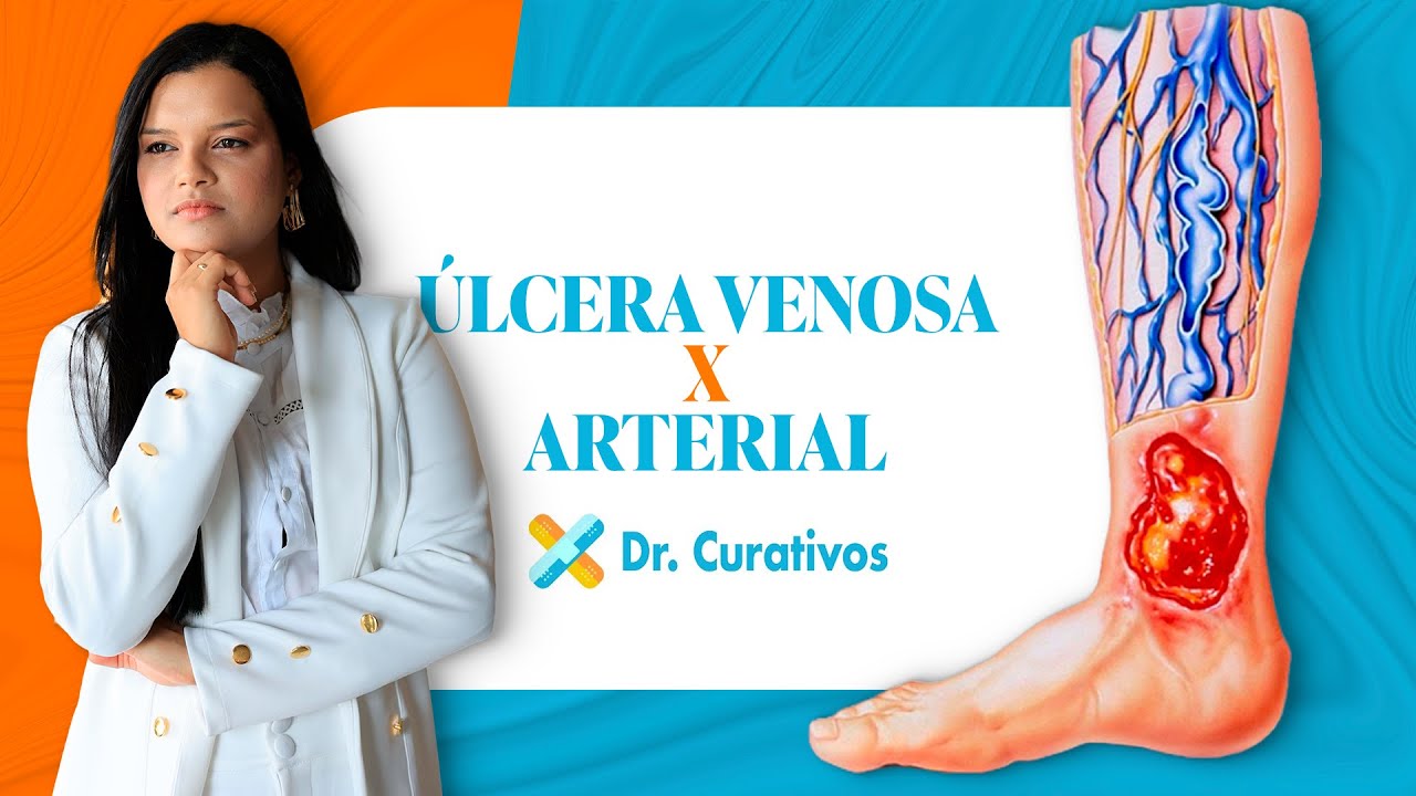 Ulcera Venosa Vs Ulcera Arterial Úlcera Venosa Instituto Belczak