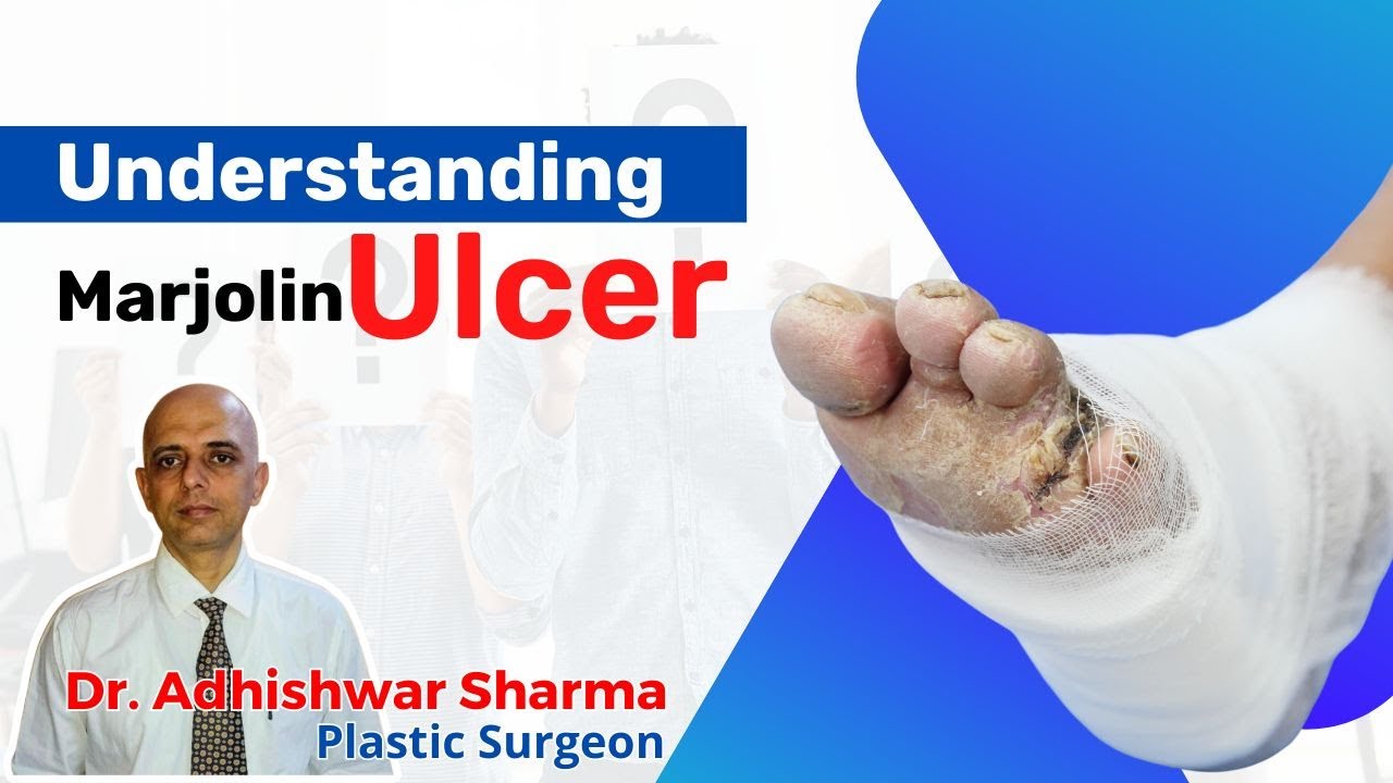Understanding Marjolin Ulcer: Causes, Diagnosis, and Treatment | Dr ...