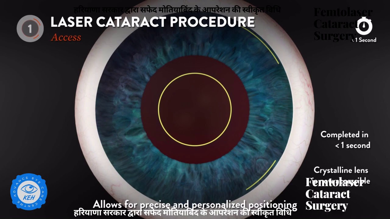 How Femtolaser Cataract surgery better than conventional Phaco surgery ...