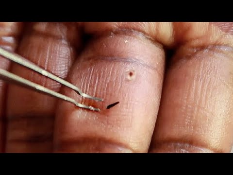 The MOST SATISFYING EXTRACTION 😯 Removing Thorns from my hand 🧐 #Shorts ...