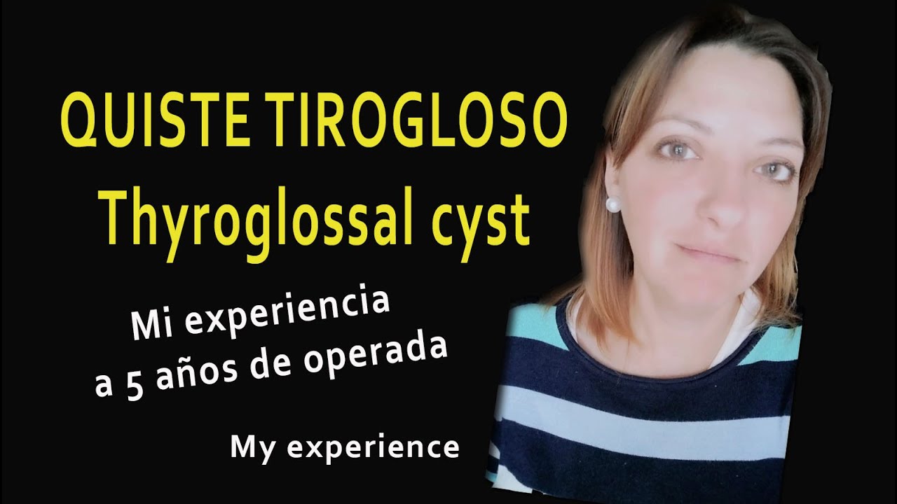 Quiste tirogloso post operatorio 5 años después (Thyroglossal cyst 5 ...
