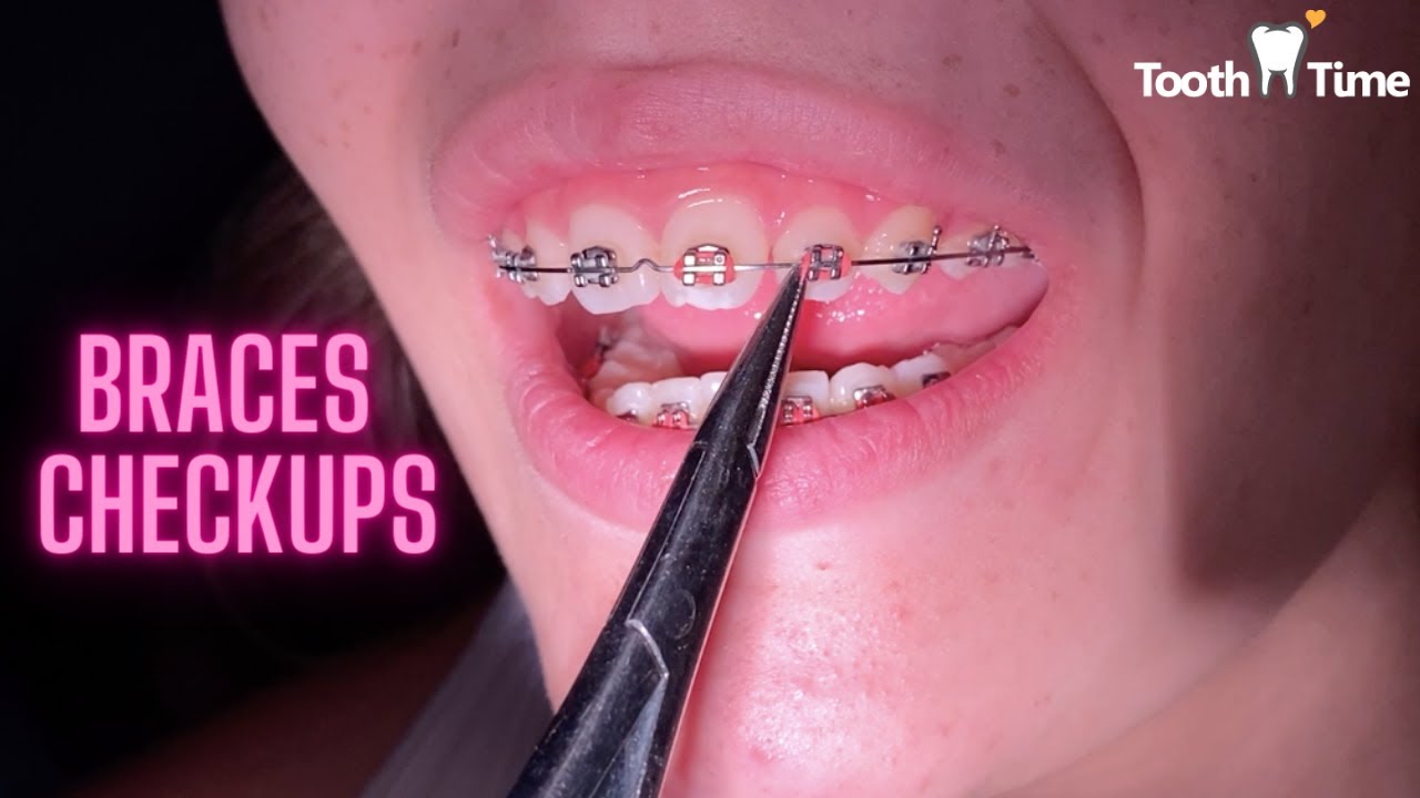 Braces Checkups - Tooth Time Family Dentistry New Braunfels - YouTube