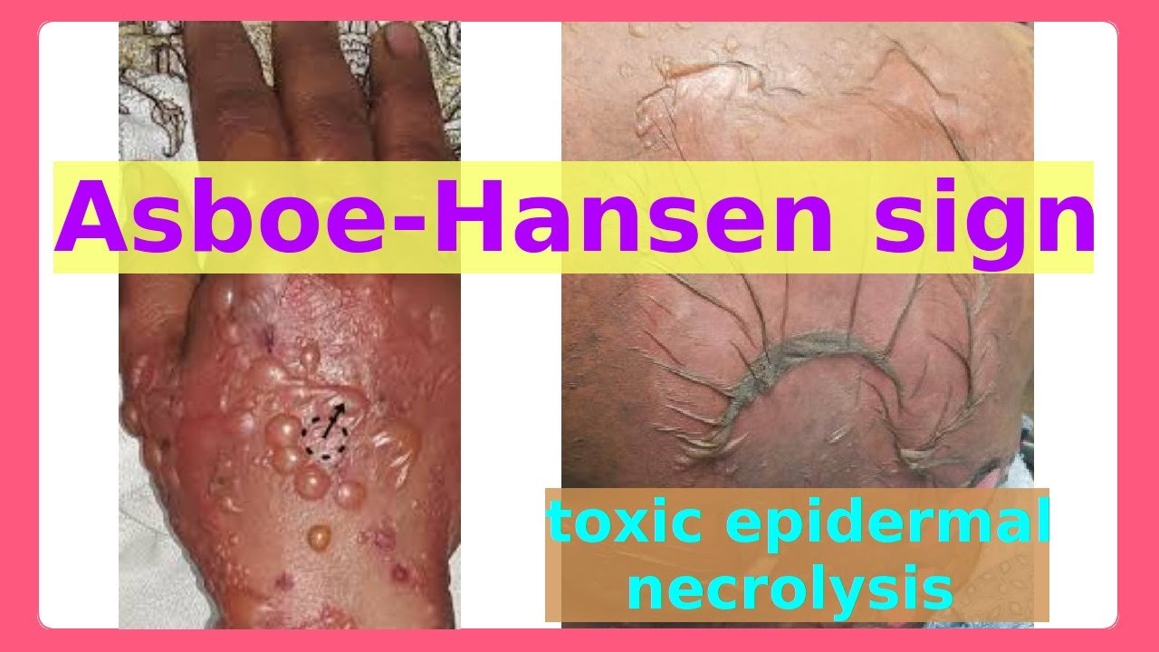 Asboe-Hansen sign - YouTube