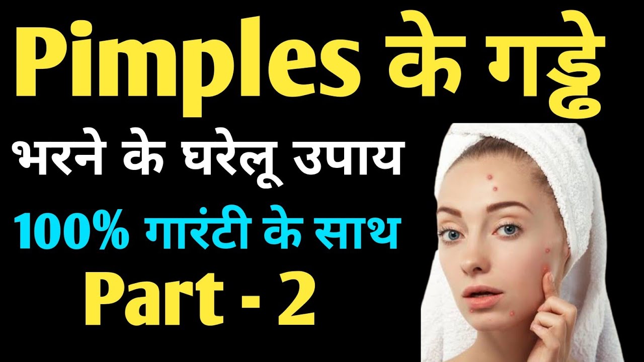 Part - 2 : Pimples ke gadde dur karne ke upay | Pimples ke daag dhabbe ...