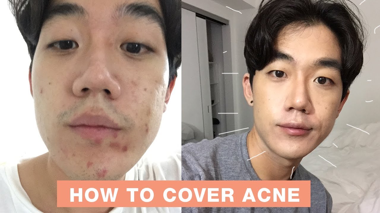 Best Makeup For Guys With Acne | Saubhaya Makeup