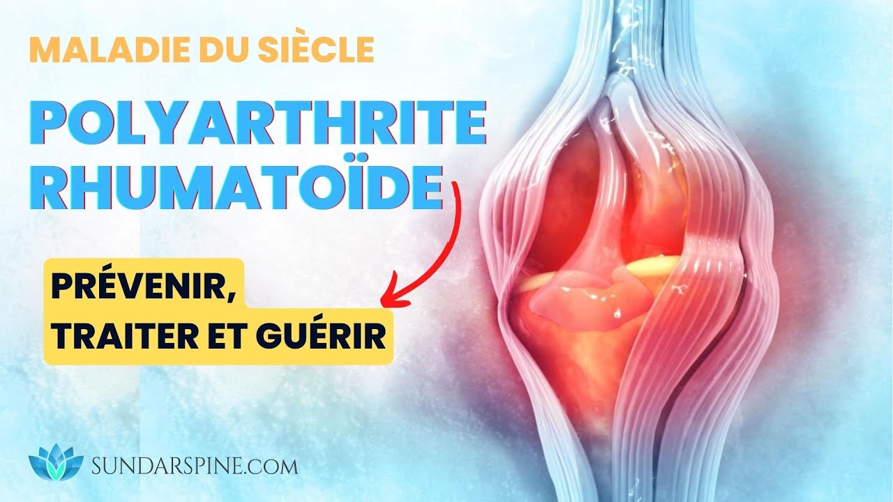 Maladie du siècle - polyarthrite rhumatoïde | Causes, prévention et ...