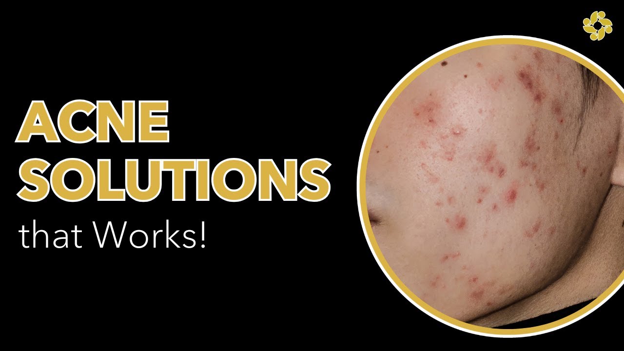 ACNE Solutions that Works! - YouTube