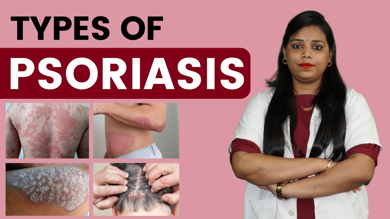 Main Types of Psoriasis | Explained in Detail by - Dr. Kanchan Singh ...