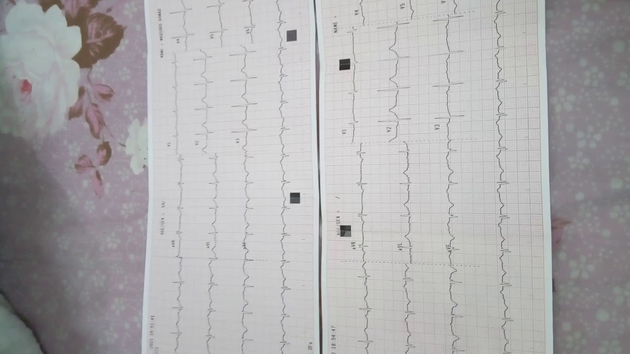 Comparative study for ECG . - YouTube
