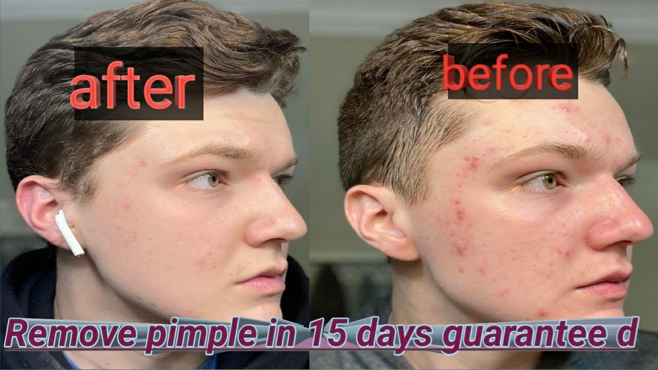 remove pimple in a week without any side effects - YouTube