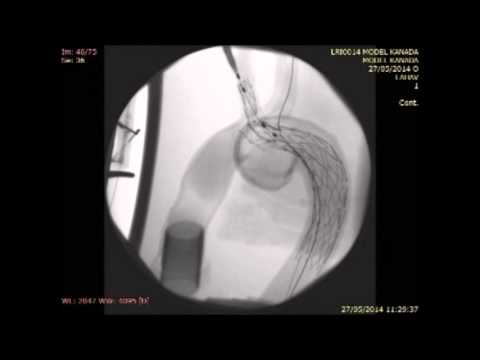 Pangolin Implantation simulator - YouTube