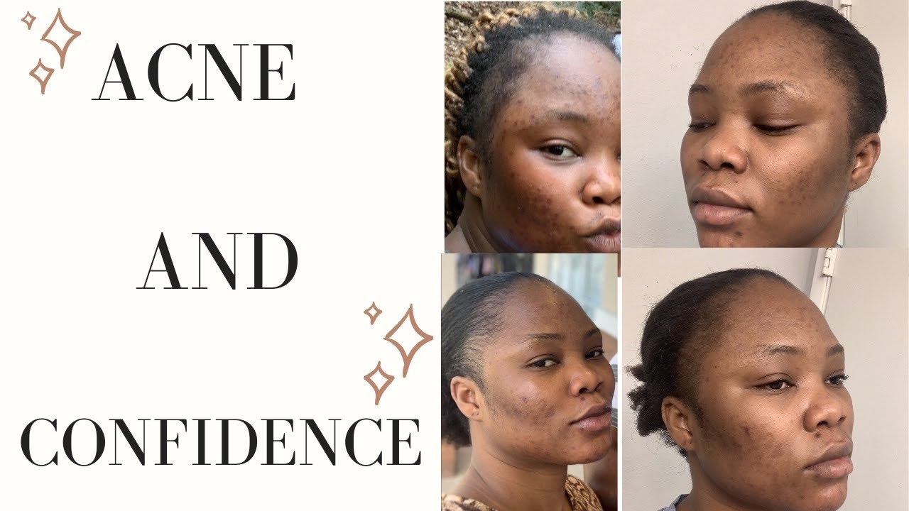 How to Have Confidence With Acne of Course - YouTube