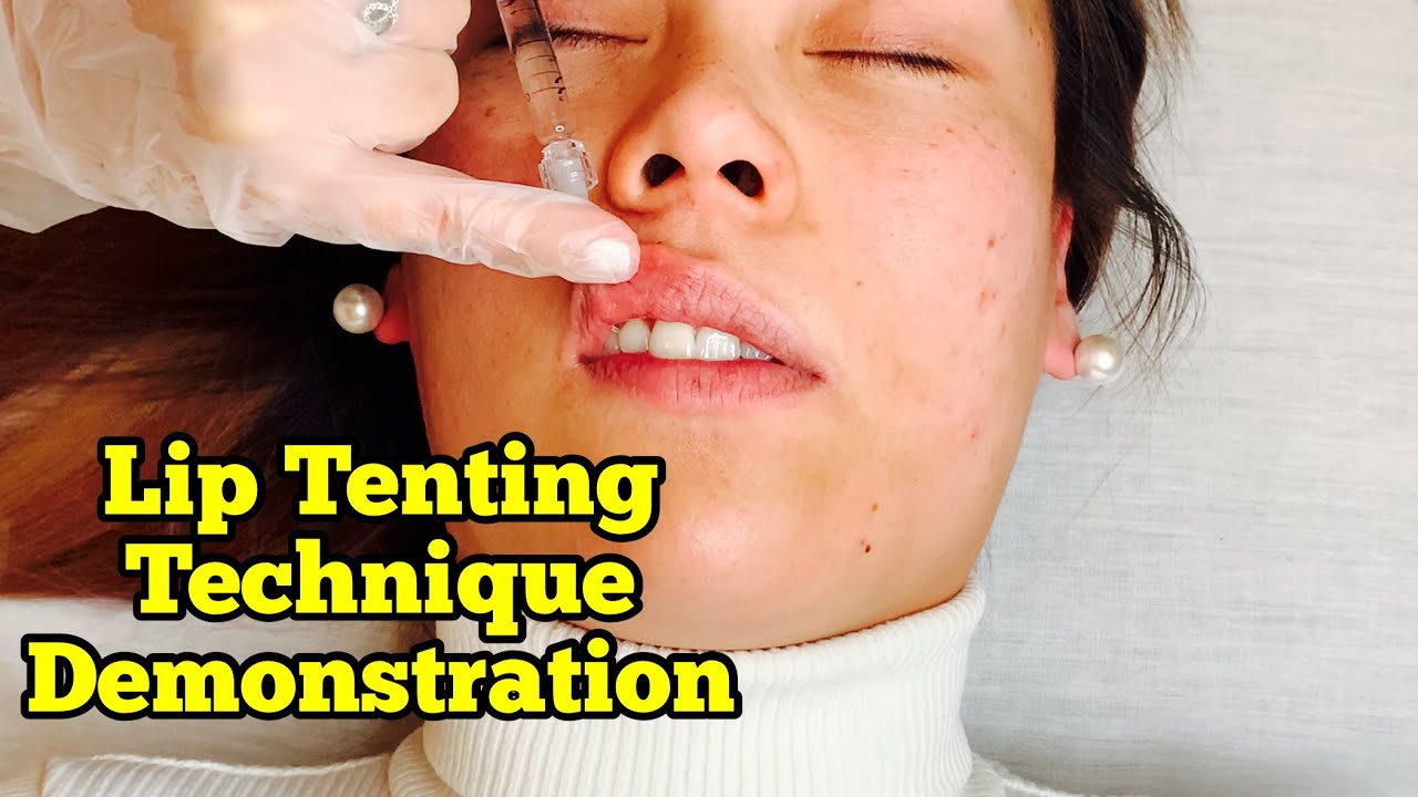 Filler Injection Tutorial 2021 - How to do Russian Lips - Lift and ...