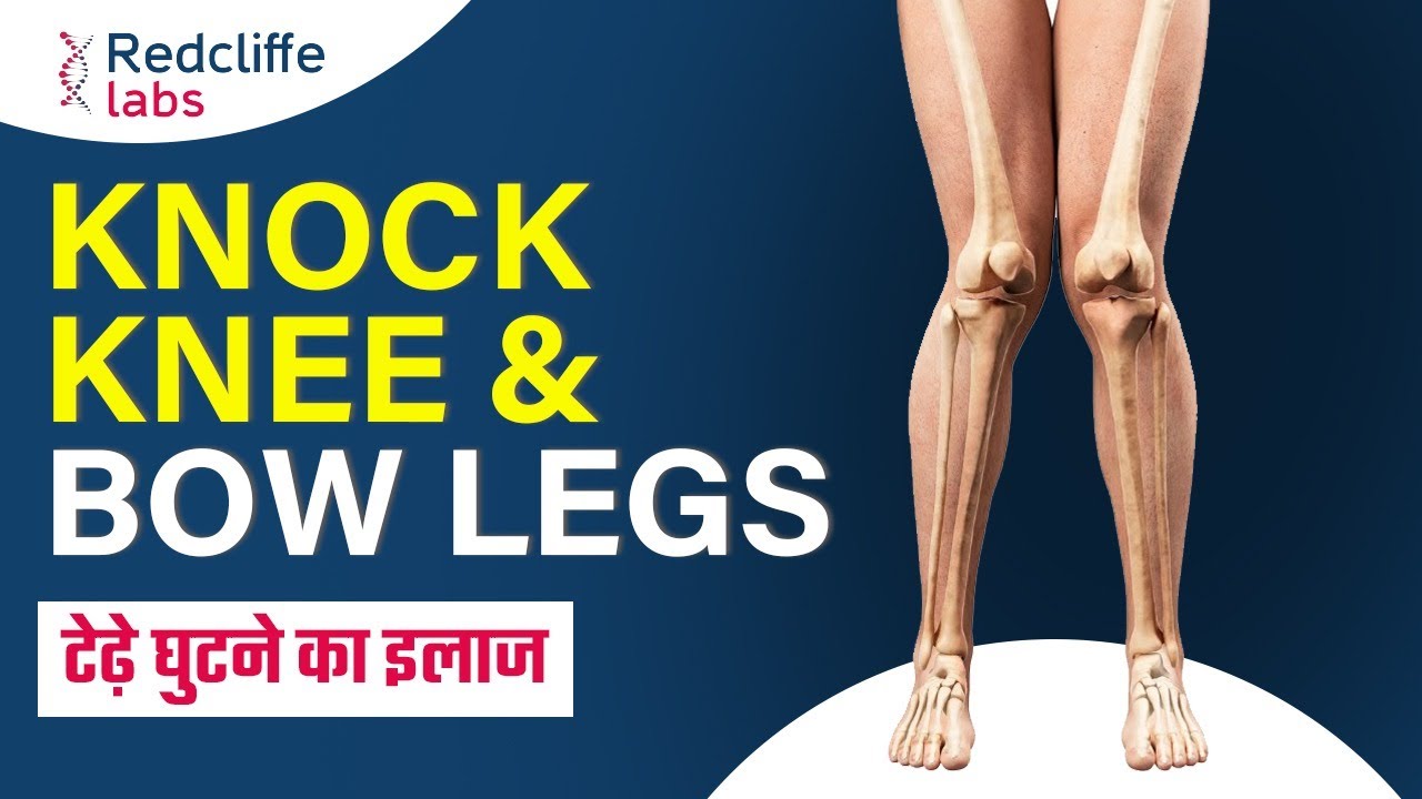 Joint/Knee Deformities | टेढ़े घुटने का इलाज | Causes/Treatment of ...