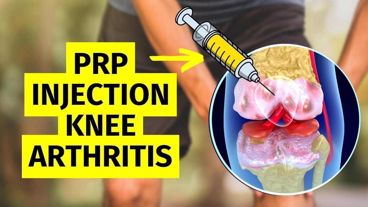 Platelet Rich Plasma Prp Injections Slow Down Knee Arthritis