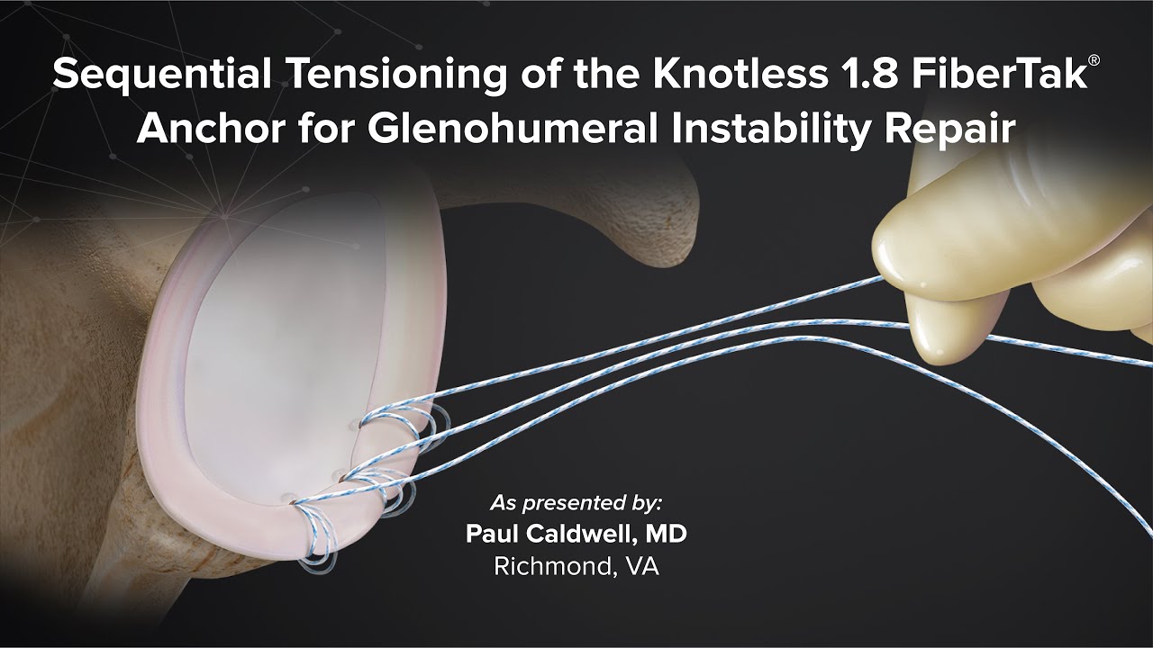 Sequential Tensioning of the Knotless 1.8 FiberTak® Anchor for ...