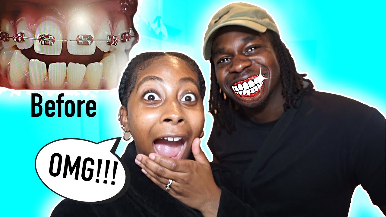 I FINALLY GOT MY BRACES REMOVED AFTER 2 YEARS!!! *Crazy Transformation ...