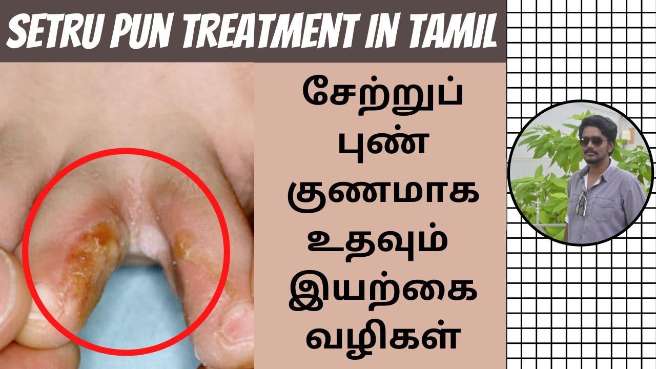 சேற்று புண் விரைவில் குணமாக இயற்கை வைத்தியம் | Kaal Setru Pun Treatment ...
